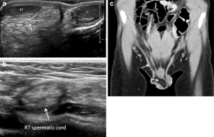 Extratesticular masses in children: taking ultrasound beyond ...