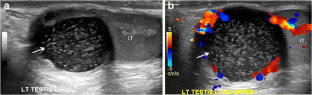 Extratesticular masses in children: taking ultrasound beyond ...