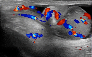 Extratesticular masses in children: taking ultrasound beyond ...