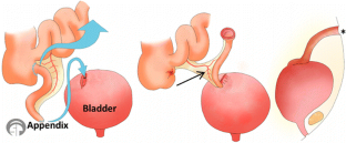 The role of imaging in pediatric bladder augmentation | SpringerLink