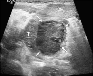 Tonsil ultrasound: technical approach and spectrum of pediatric ...