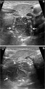 Tonsil ultrasound: technical approach and spectrum of pediatric ...