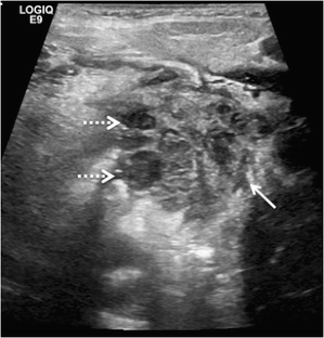 Tonsil ultrasound: technical approach and spectrum of pediatric ...