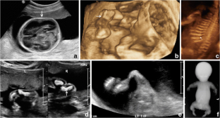 Evaluating skeletal dysplasias on prenatal ultrasound: an emphasis on ...