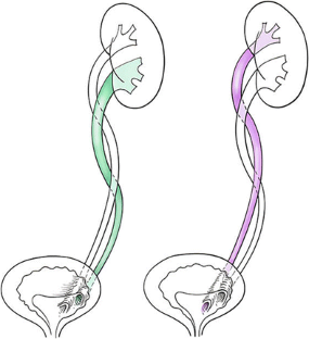 The duplicated collecting system of the urinary tract: embryology ...