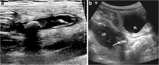 Ultrasound of the pediatric appendix | SpringerLink