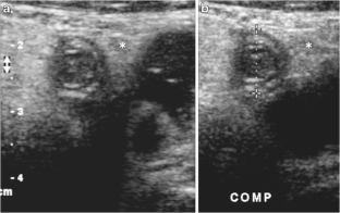 Ultrasound of the pediatric appendix | SpringerLink