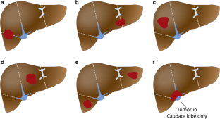 2017 PRETEXT: radiologic staging system for primary hepatic ...