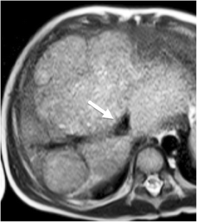 2017 PRETEXT: radiologic staging system for primary hepatic ...