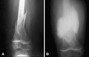 Hyperplastic callus formation in osteogenesis imperfecta type V ...