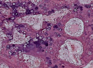 Hyperplastic callus formation in osteogenesis imperfecta type V ...