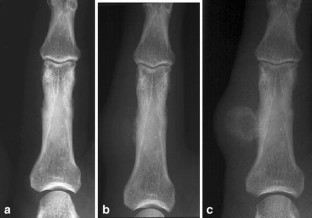 Nora’s lesion, a distinct radiological entity? | SpringerLink