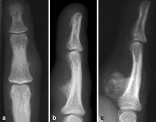 Nora’s lesion, a distinct radiological entity? | SpringerLink
