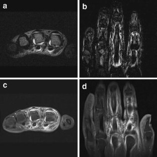 Enhanced MR imaging of tenosynovitis of hand and wrist in inflammatory ...