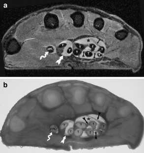 Radial and ulnar bursae of the wrist: cadaveric investigation of ...