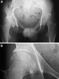 Acetabular retroversion as a rare cause of chronic hip pain ...