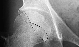 Acetabular retroversion as a rare cause of chronic hip pain ...