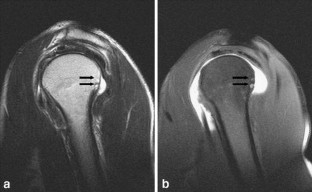 Humeral head cysts and rotator cuff tears: an MR arthrographic study ...