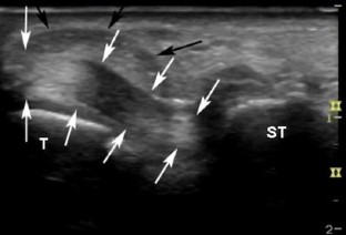Sonography of the superomedial part of the spring ligament complex of ...