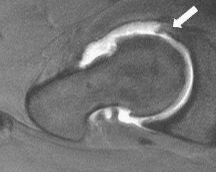Classification and localization of acetabular labral tears | SpringerLink