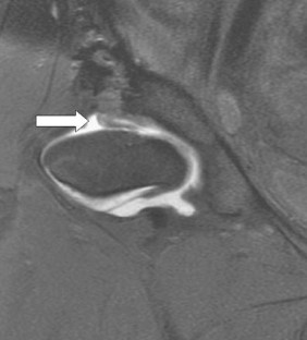 Classification and localization of acetabular labral tears | SpringerLink