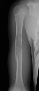 The “rising bubble” sign: a new aid in the diagnosis of unicameral bone ...