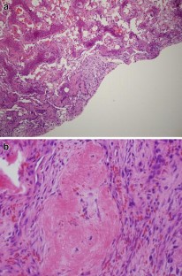 The “rising bubble” sign: a new aid in the diagnosis of unicameral bone ...