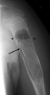 The “rising bubble” sign: a new aid in the diagnosis of unicameral bone ...