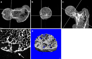 Herniation pits and cystic-appearing lesions at the anterior femoral ...