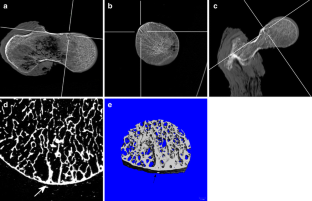 Herniation pits and cystic-appearing lesions at the anterior femoral ...