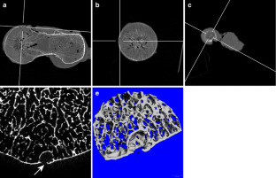 Herniation pits and cystic-appearing lesions at the anterior femoral ...