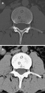 Bony sequestrum: a radiologic review | SpringerLink