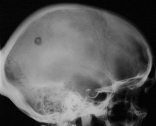 Bony sequestrum: a radiologic review | SpringerLink