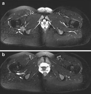 Case report: imaging and surgical treatment of a snapping hip due to ...