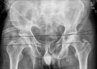 Relationship between Wiberg's lateral center edge angle, Lequesne's ...