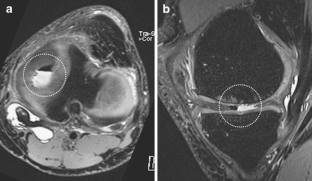 Vacuum phenomenon: prevalence and appearance in the knee with 3 T ...