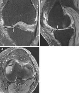 Vacuum phenomenon: prevalence and appearance in the knee with 3 T ...
