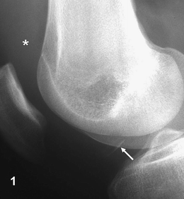 The “sliver sign”: a specific radiographic sign of acute lateral ...