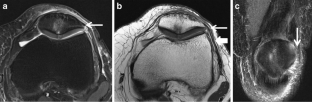 High resolution magnetic resonance imaging of the patellar retinaculum ...