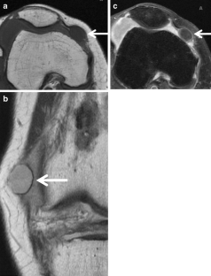 High resolution magnetic resonance imaging of the patellar retinaculum ...