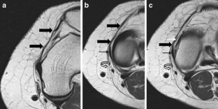 High resolution magnetic resonance imaging of the patellar retinaculum ...