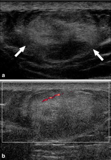 Ultrasonographic analysis of subcutaneous angiolipoma | SpringerLink