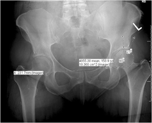 Normal values of Wiberg’s lateral center-edge angle and Lequesne’s ...