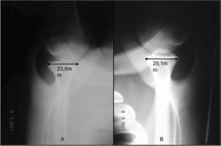Calculating anterior glenoid bone loss using the Bernageau profile view ...