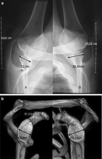 Calculating anterior glenoid bone loss using the Bernageau profile view ...