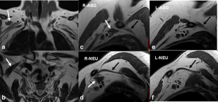 MRI findings in thoracic outlet syndrome | SpringerLink