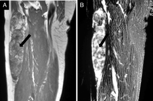 MRI characteristics of lipoma and atypical lipomatous tumor/well ...
