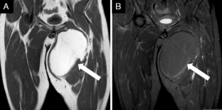 MRI characteristics of lipoma and atypical lipomatous tumor/well ...