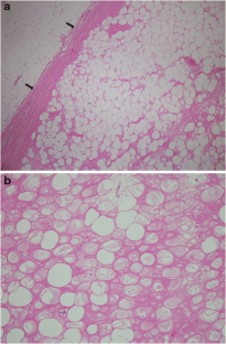Encapsulated fat necrosis mimicking subcutaneous liposarcoma ...