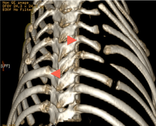 Multi-detector thoracic CT findings in cerebro-costo-mandibular ...
